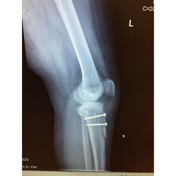 Sabrina, Lateral Release, Fulkerson Osteotomy, and Medial Reefing ...