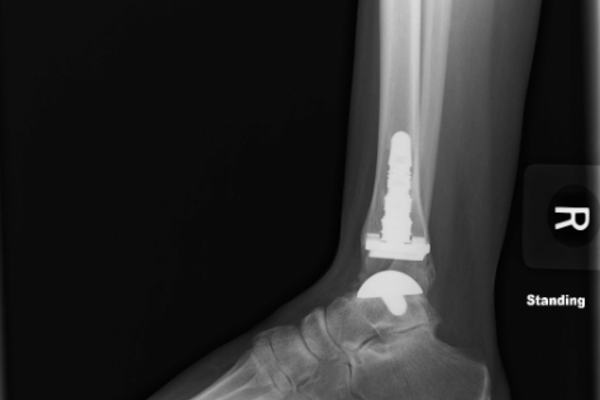 Getting a Total Ankle Replacement Procedure vs. Having Ankle Fusion ...