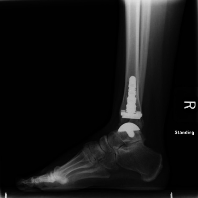 Getting a Total Ankle Replacement Procedure vs. Having Ankle Fusion ...