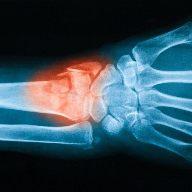10 Facts To Know About Your Wrist Fracture Procedure | Rothman ...