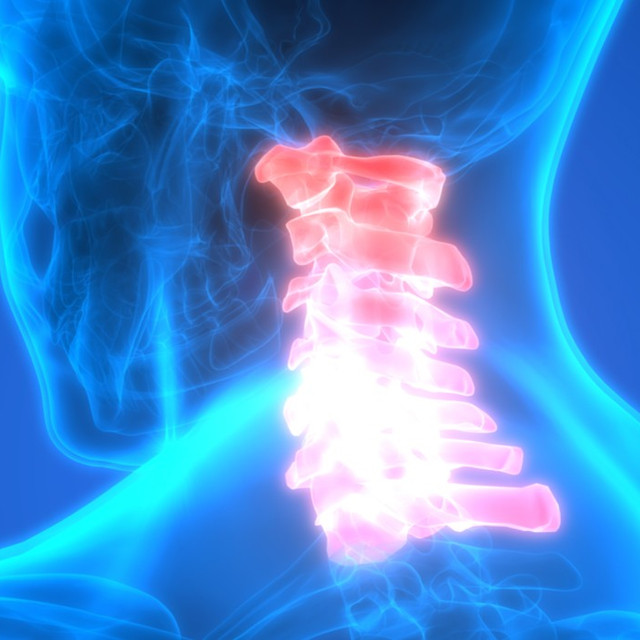 Top Three Best Methods for Cervical Herniated Disc Treatment in NYC ...